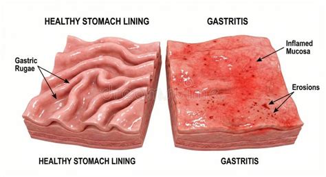 Gerd Acid Reflux Gastritis Comparison Cross Section Shows Healthy
