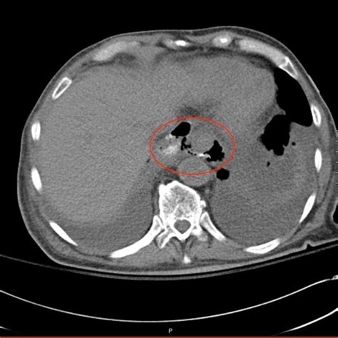 Chest Computed Tomography With Oral And Without Intravenous Contrast On Download Scientific