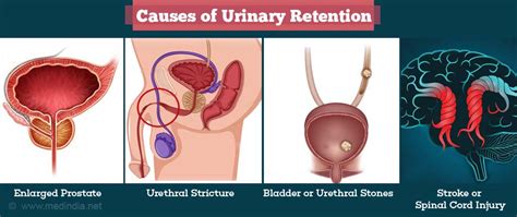 Urinary Retention Types Causes Symptoms Diagnosis Treatment