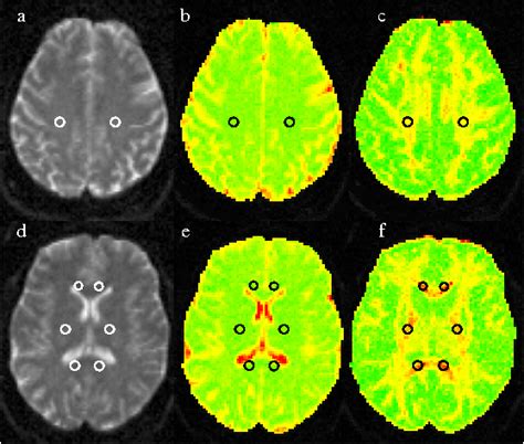 Diffuse Axonal Injury Mri