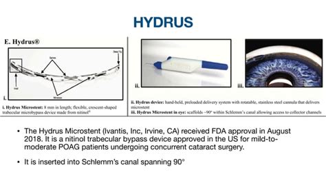 Microinvasive Glaucoma Surgery Migs Pdf