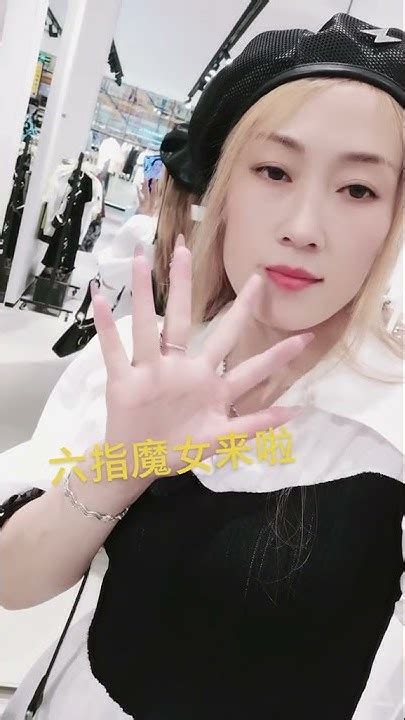 Polydactyly 34 Youtube