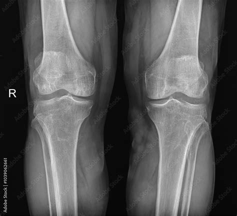 X Ray Imaging Of Bilateral Knee Joints For Detecting Arthritis And