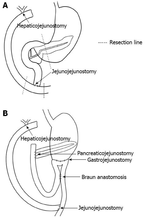Gastrojejunostomy Hepaticojejunostomy