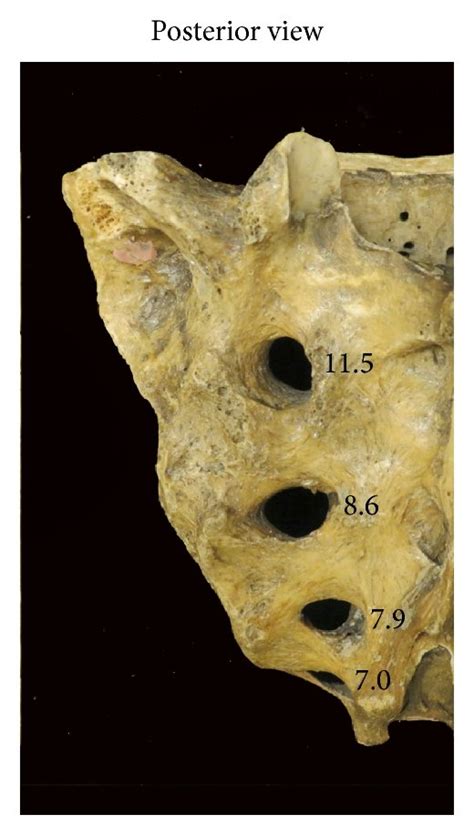 Variation In The Shape And Size Of The Posterior Sacral Foramina A