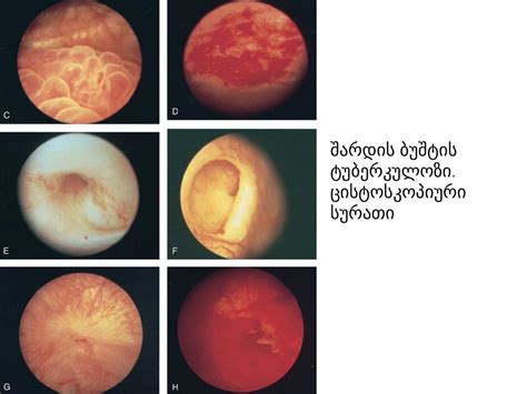 საშარდე გზების ინფექციები ლექცია 5 Online Presentation