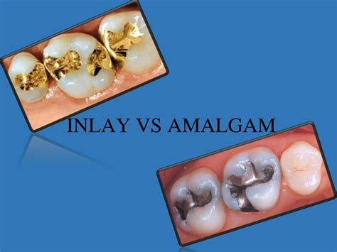 Solution 16 Inlay Vs Amalgam Class Studypool