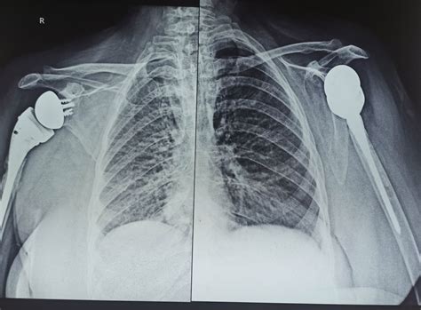 Shoulder Replacement