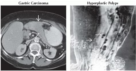 Da4 Db1 Gastricmasslesions Ffu3 Abdominal Key