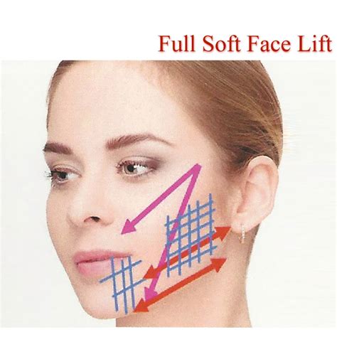 Lower Chin And Jaw Pdo Threads Allurant Medical Spa