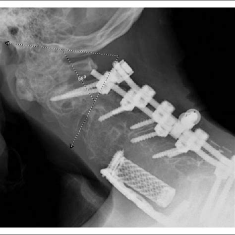 Posterior Neck Muscles Activated In Neck Extension Extensors