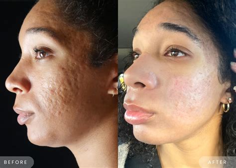 How Skin Type And Genetics Impact Acne Scars