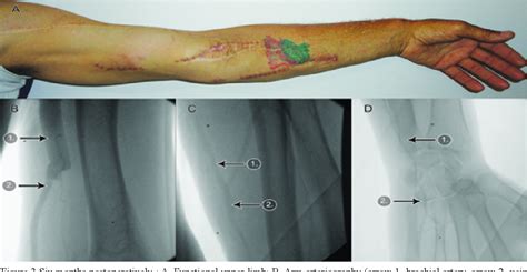 Figure 3 From Extra Anatomic Artery Bypass For Large Brachial Pseudoaneurysm Related To Vascular