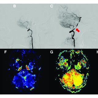 A B Right Vertebral Artery Occlusion C D Left Dominant Vertebral Download Scientific