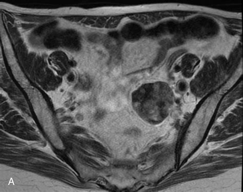Solid Adnexal Lesions Radiology Key