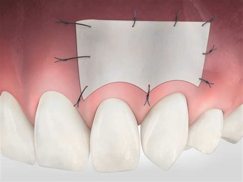 Increasing Keratinized Tissue