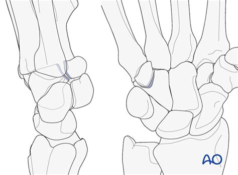 Hamate Hook Fracture