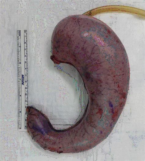 A New Emerging Procedure — Sleeve Gastrectomy Intechopen