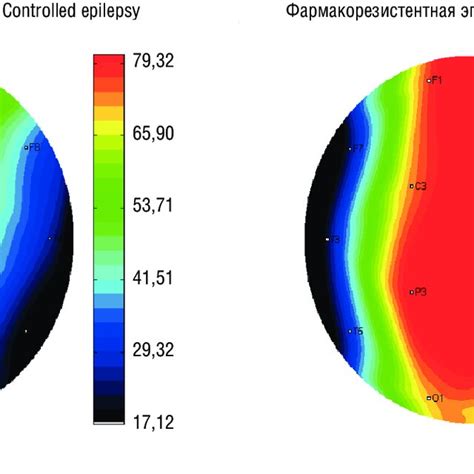 Topograms Of The Spectral Power Of Paroxysmal Activity In The Theta