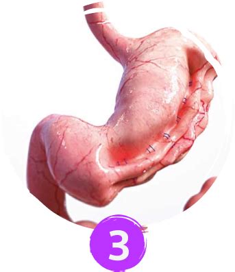 Esto debes saber de la gastroplastia endoscópica | MásQuePeso