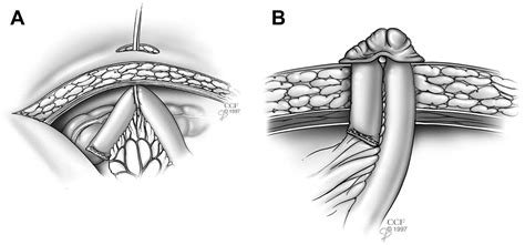 Intestinal Stomas Advances In Surgery