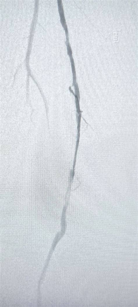 Distal Sfa Cto Treated With Serranator For Significant Luminal Gain