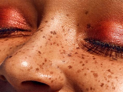 Freckles All Over Body