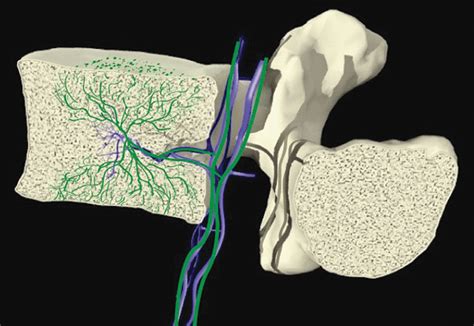 Complications Of Basivertebral Nerve Ablation Anesthesia Key