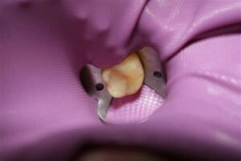 5 Reasons Why Dental Dam Should Be Used For Dental Treatments