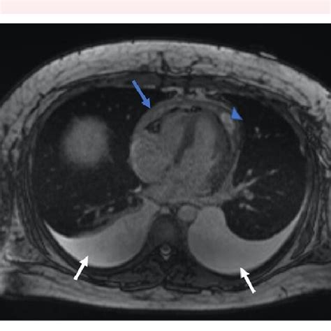 Cardiac Magnetic Resonance True Fast Imaging With Steady State Free Download Scientific Diagram