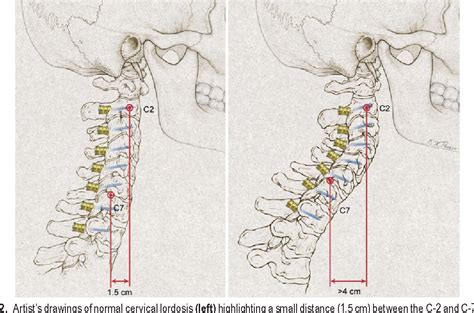 Figure 1 From Cervical Spine Alignment Sagittal Deformity And Clinical Implications