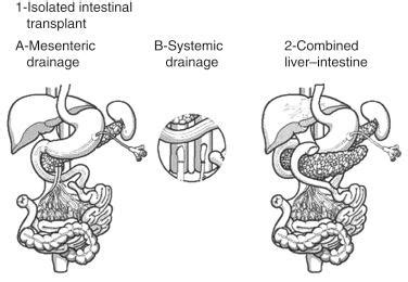 Intestinal And Multivisceral Transplantation Clinical Tree