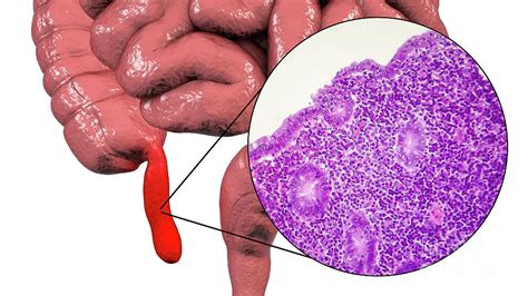Acute Suppurative Appendicitis 6 By Science Photo Library