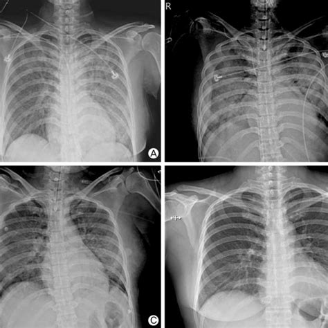 A A Chest X Ray At Presentation Shows Diffuse Bilateral Infiltration Download Scientific