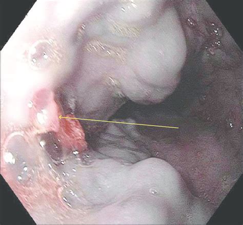 Esophagoscopy Of The Midesophagus Demonstrating Grade Iii Varices And