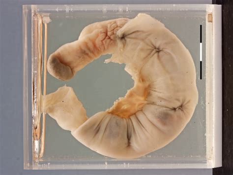 Gastrointestinal Pathology Small Intestine Intussusception Of Meckels Diverticulum Podcasts