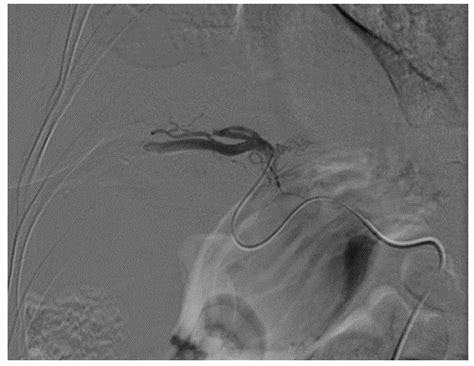 Trans Arterial Embolization Of A Giant Hepatic Hemangioma Prior To