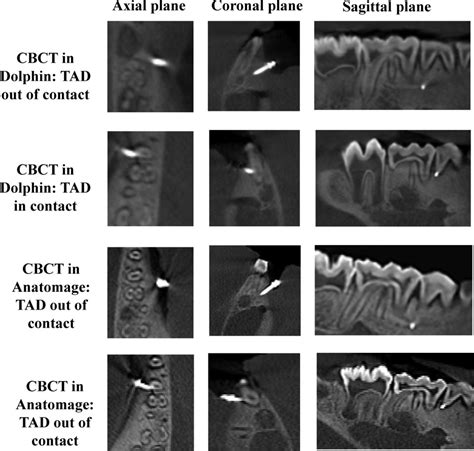 Reliability And Accuracy Of Assessing Temporary Anchorage Device Tooth Root Contact With Cone