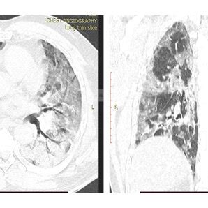 A Years Old Male Patient From First Wave With Bilateral Diffuse Download Scientific Diagram