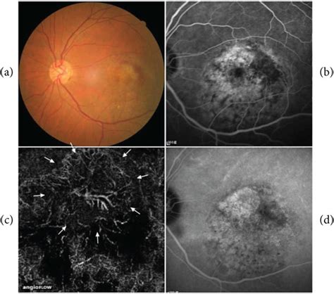Occult Choroidal Neovascularization Occult Cnv Could Be Misdiagnosed Download Scientific