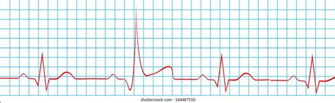 Heart Attack Stroke On Electrocardiogram Record Stock Vector Royalty
