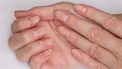 ¿qué Significa Para La Salud Tener Rayas En Las Uñas Y Surcos