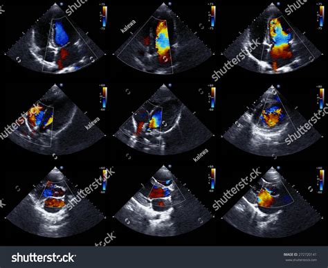 Cardiac Ultrasound Images Color Doppler Echo Stock Photo 272720141 Shutterstock