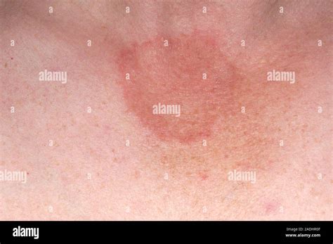 Ringworm Fungal Infection On The Skin At The Base Of A 52 Year Old Man