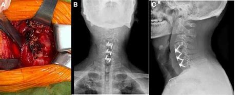 A Shows The Exposure Of Anterior Osteophytes During Operation Bc Download Scientific