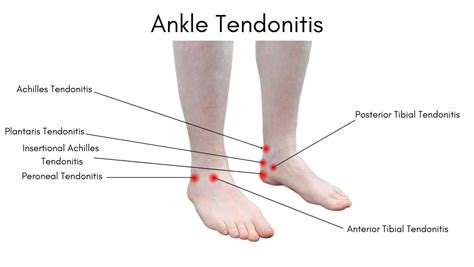 Runners Ankle Tendonitis At Paul Jamison Blog