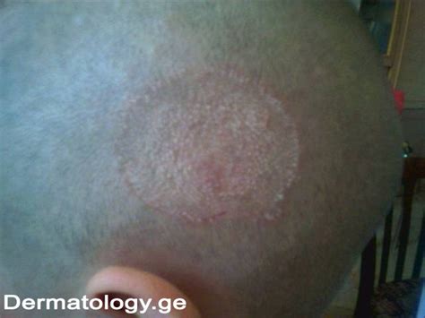 სოკოვანი დაავადებები Dermatology Ge