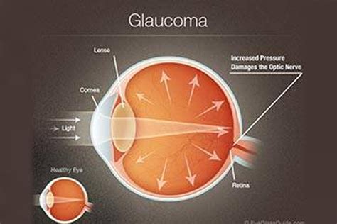 7 Facts About Glaucoma How Common Is Glaucoma And Prevention Tips