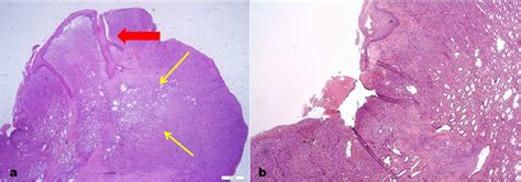 Hpe Sections Revealed A A Polypoidal Lesion Composed Of Aggregates Of Download Scientific