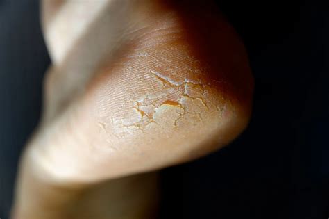 Dry Skin Causes Symptoms And Treatment For Your Feet